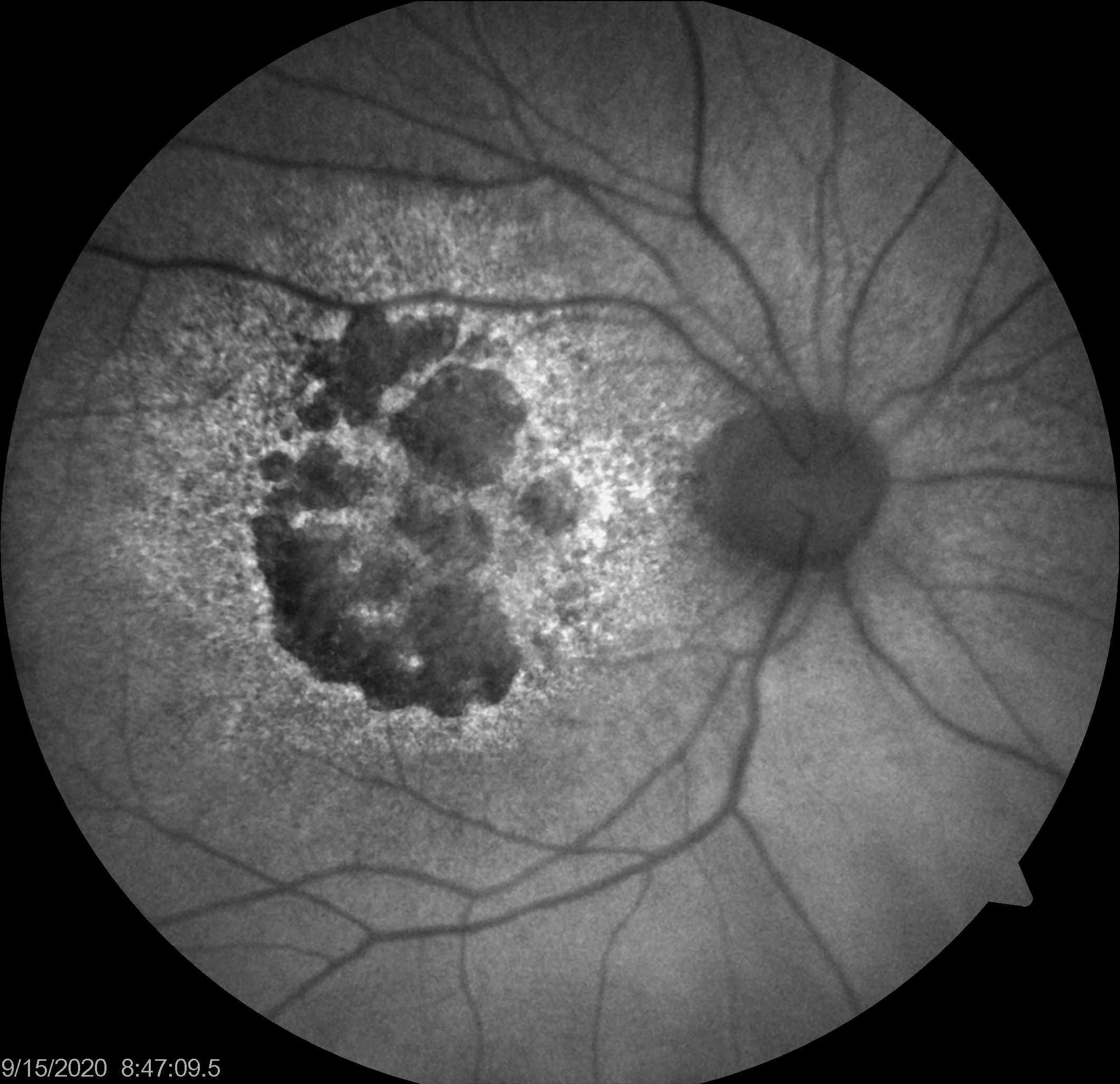 Next Generation Treatment Options for Advanced AMD | Retina Consultants ...